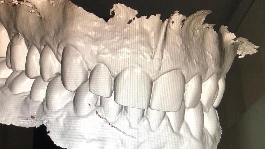 Invisalign Digital Scan | Blog | Dr. Bracy DDS West Village